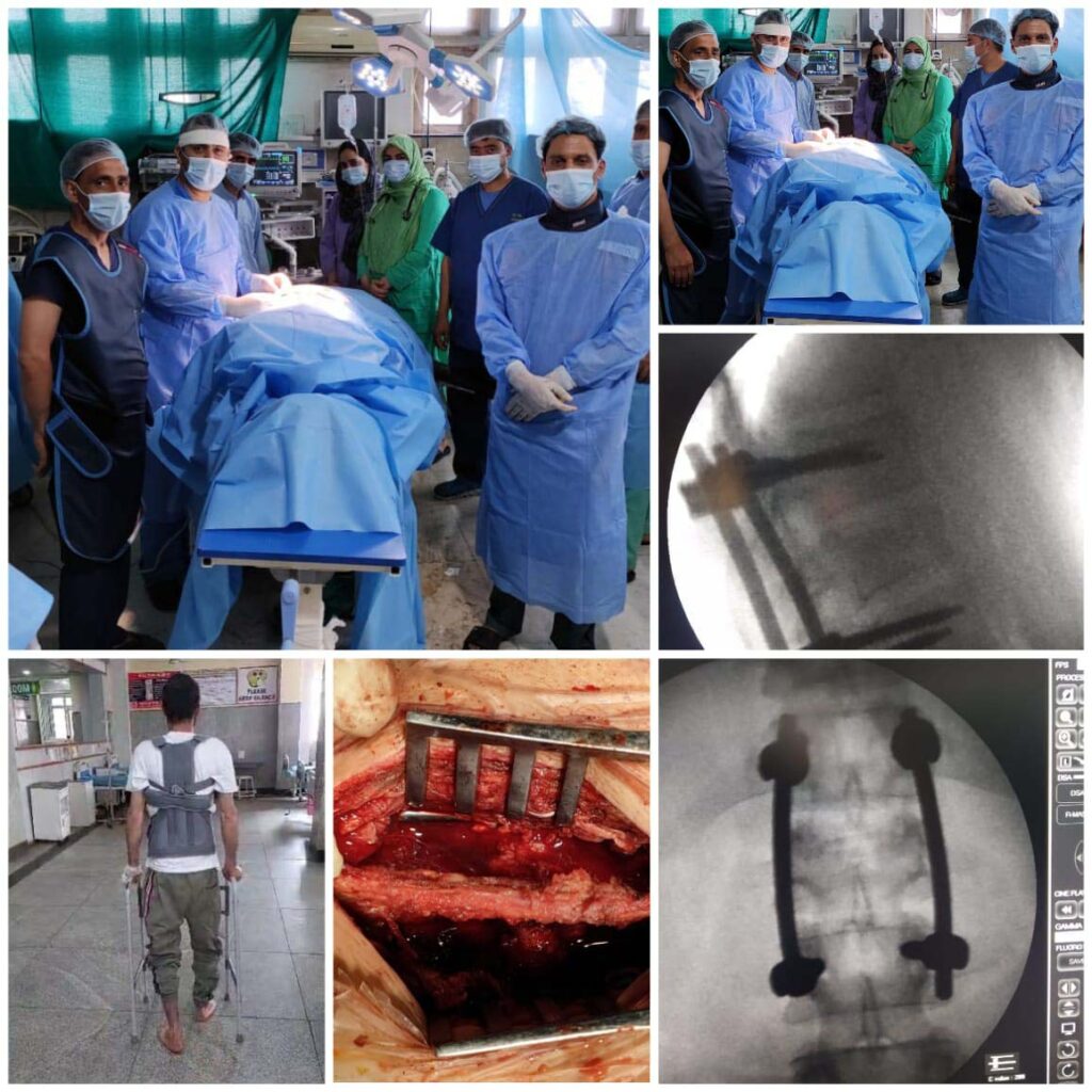 Complex Spine Surgery Successfully Conducted At DH Kulgam Latest News complex-spine-surgery-successfully-conducted-at-dh-kulgam-latest-news